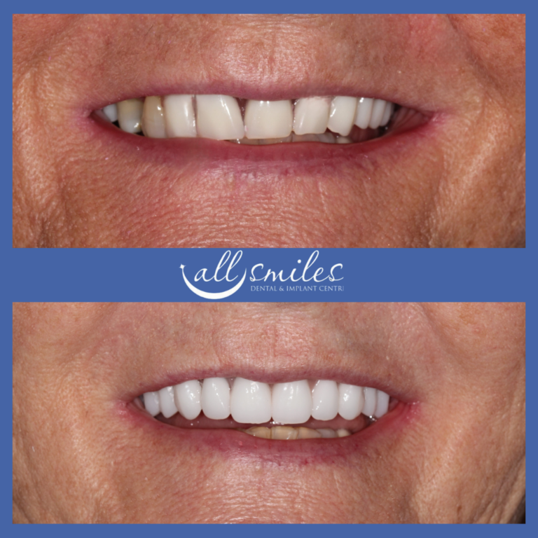Same Day Teeth (All-On-4)Dental Implants – All Smiles Dental