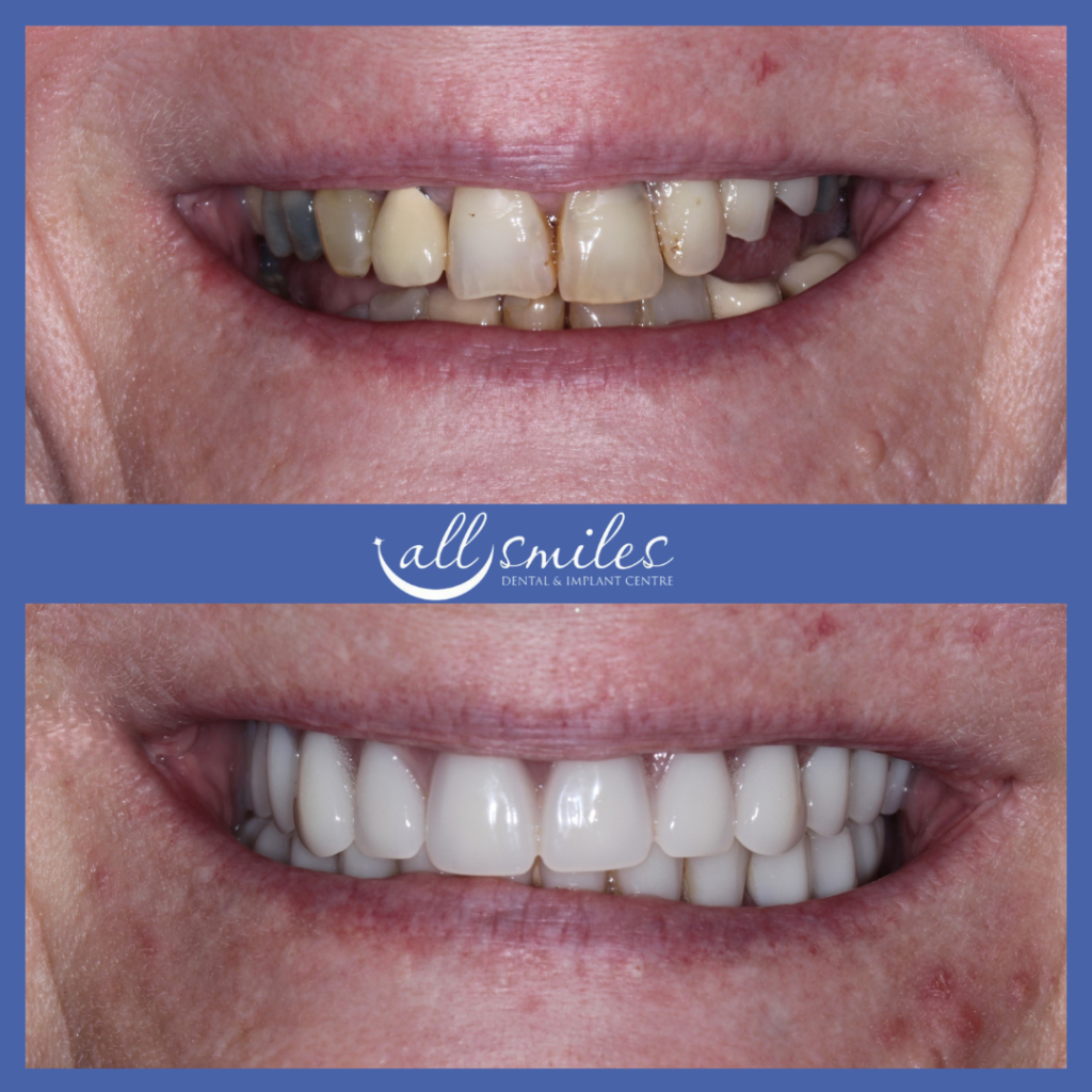 Same Day Teeth (All-On-4)Dental Implants – All Smiles Dental