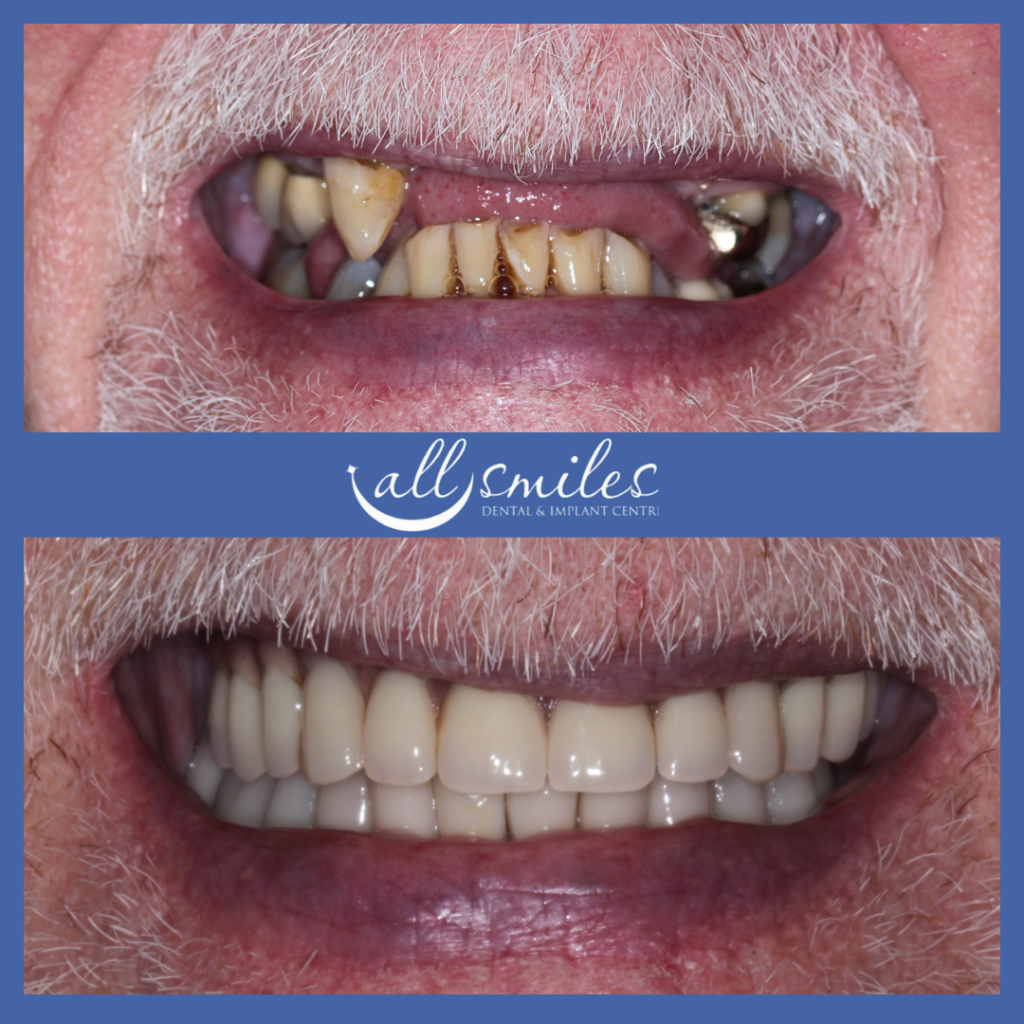 Same Day Teeth (All-On-4)Dental Implants – All Smiles Dental