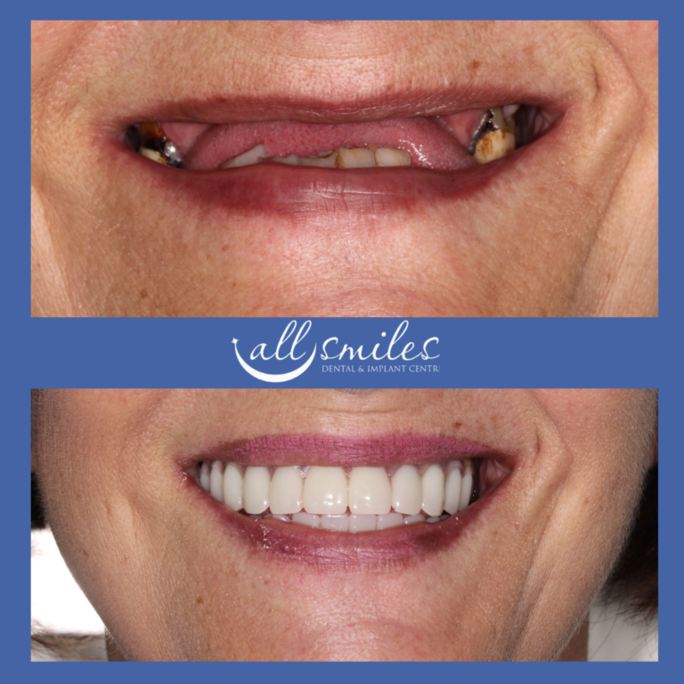 Same Day Teeth (All-On-4)Dental Implants – All Smiles Dental