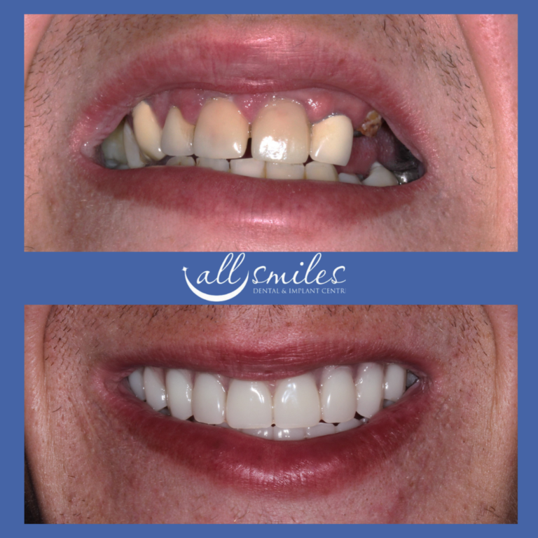 Same Day Teeth (All-On-4)Dental Implants – All Smiles Dental
